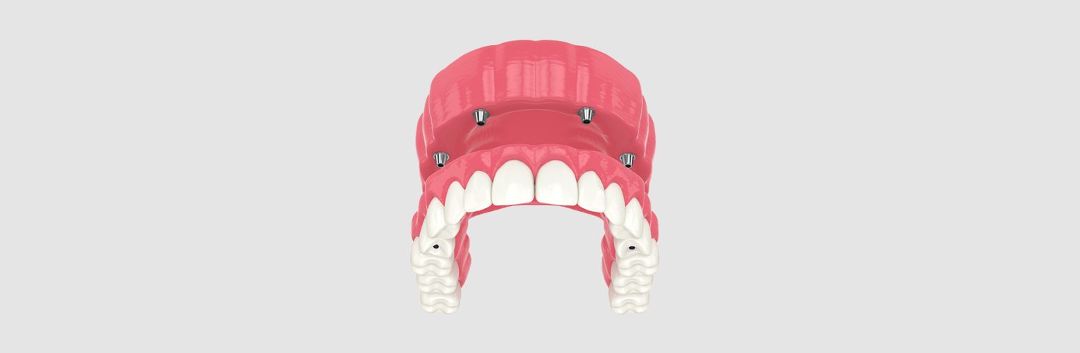 What Are the Trusted Options for Multiple Tooth Replacement in Vancouver?